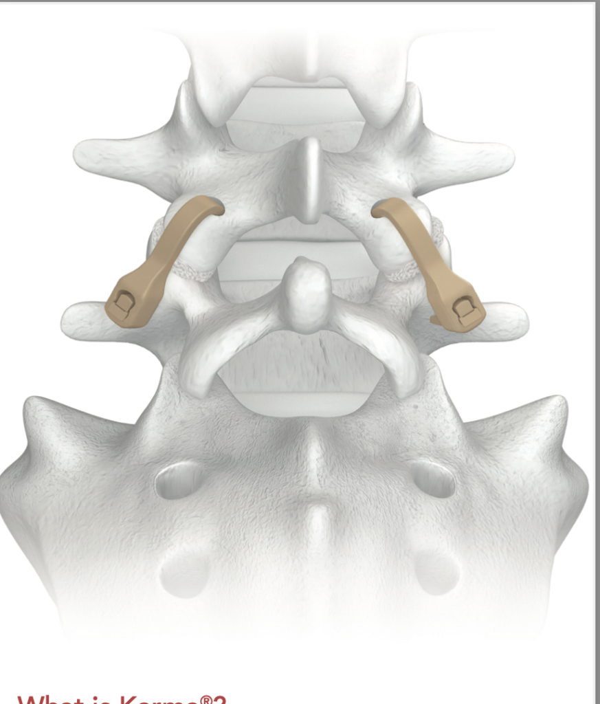 What is Karma®? | DOCS Spine Orthopedics